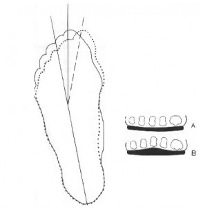 Biomechanics of hallux valgus and spread foot